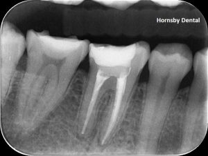 Root Canal Therapy | North Sydney Dentistry
