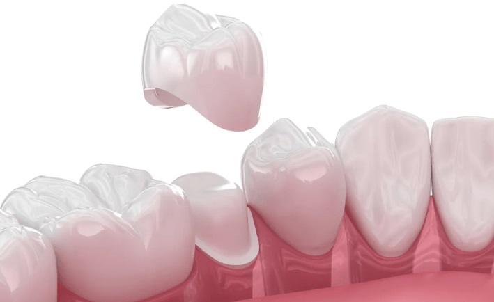 Tooth Cap | North Sydney Dentistry | North Sydney Dental | North Sydney ...